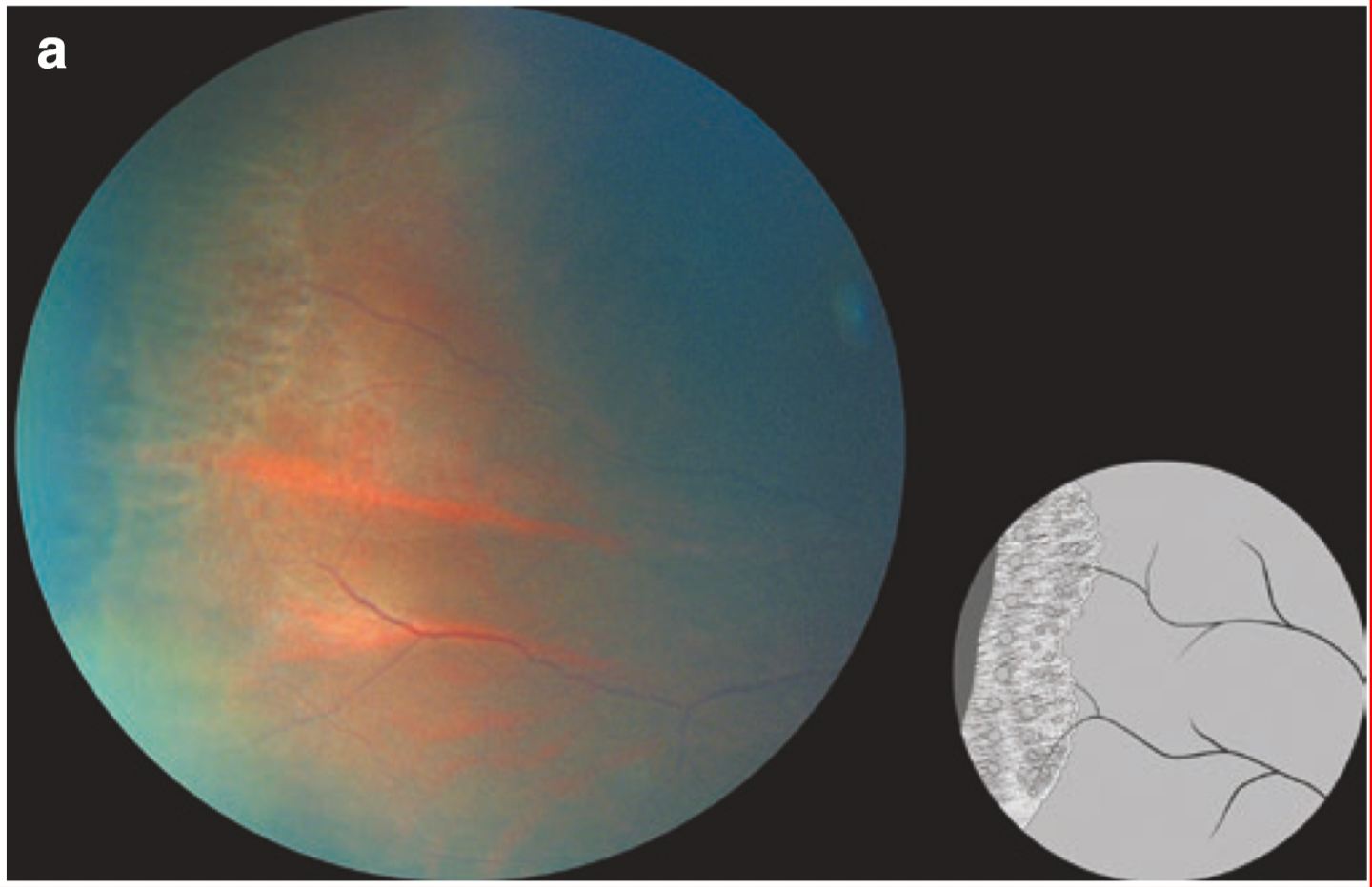 낭포 변성(cystoid degeneration) - 망막 주변부 변성 4