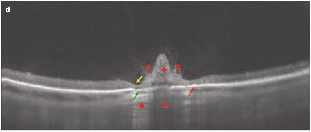 망막술(retinal tufts) - 망막 주변부 변성 8