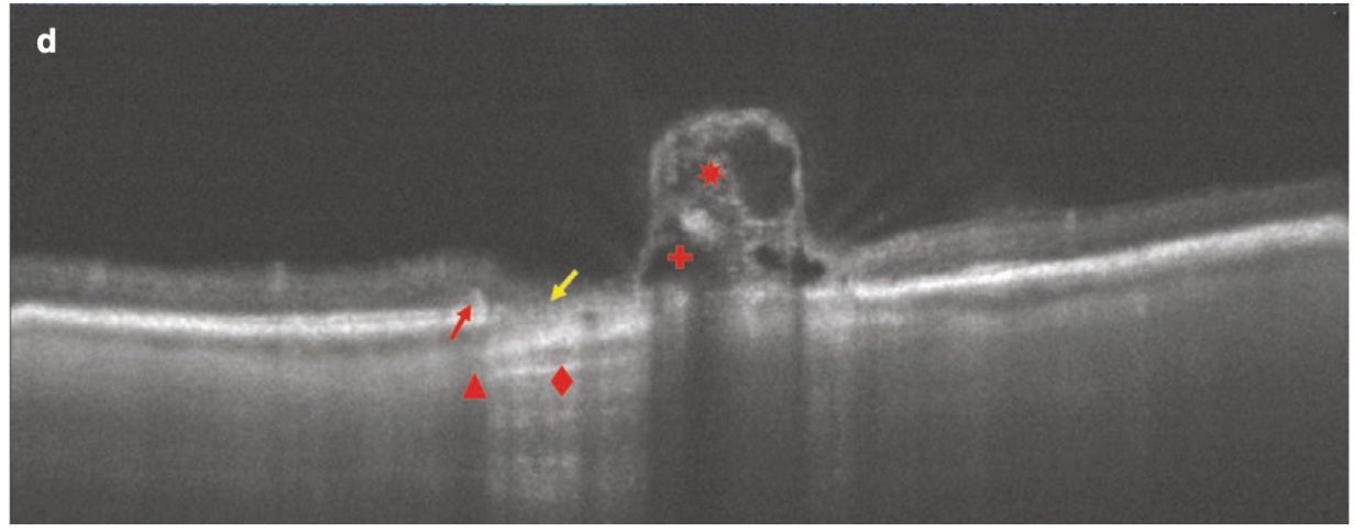 망막술(retinal tufts) - 망막 주변부 변성 8